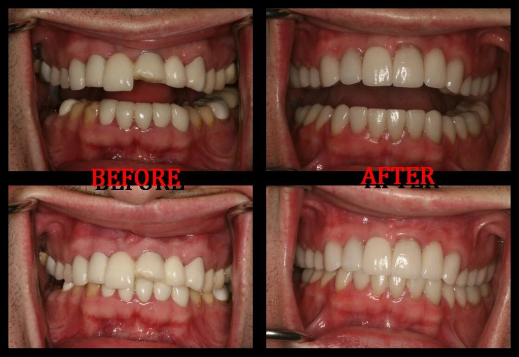 Dental Implants: Only Part of the Journey to a Restored Smile